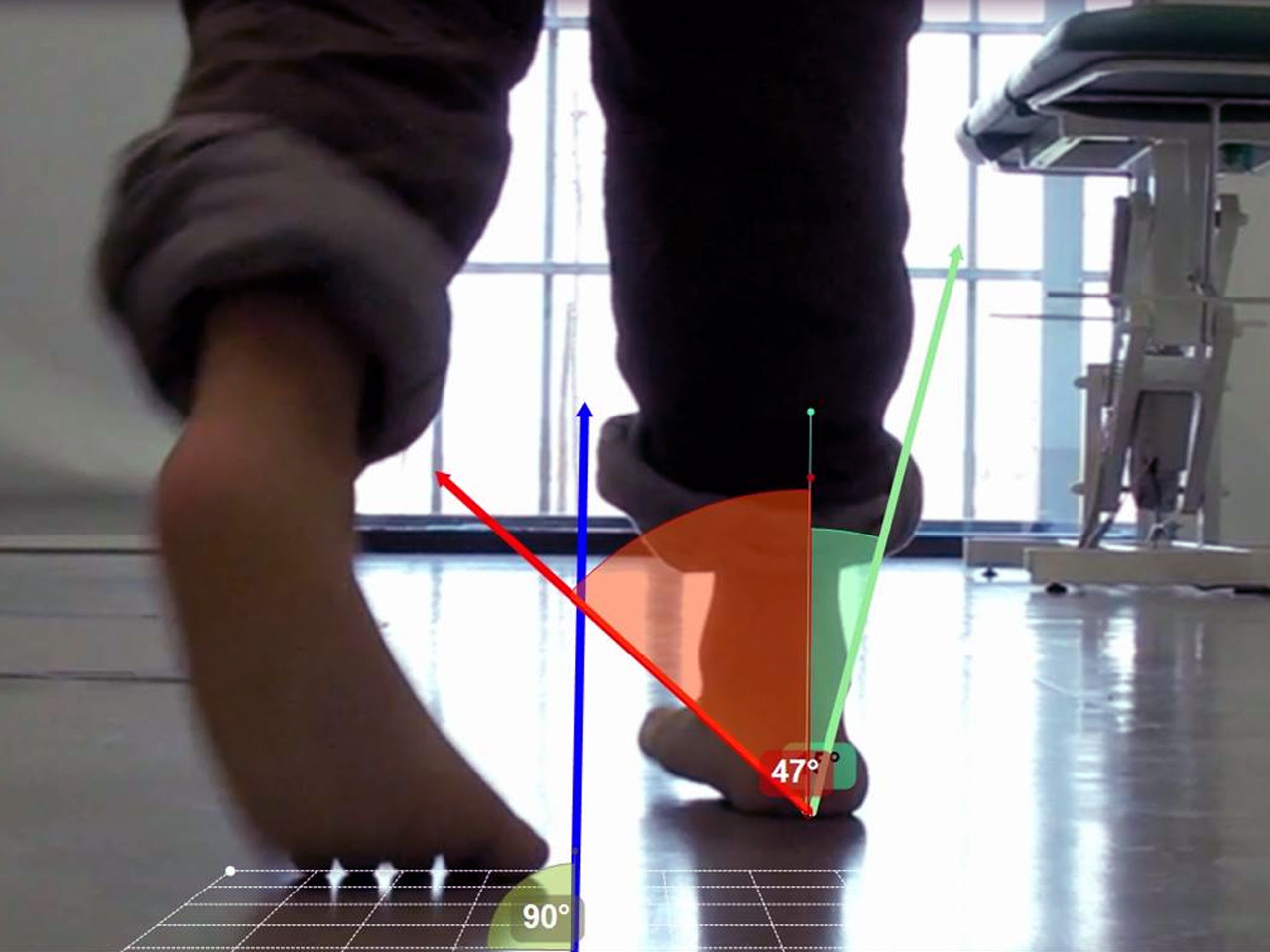 ¿Qué es la marcha infantil en adducción? Observemos un poco más esos ...